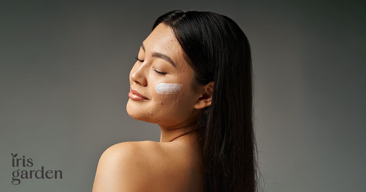Pimple Removal Cream for Oily Skin & Daily Use | Iris Garden